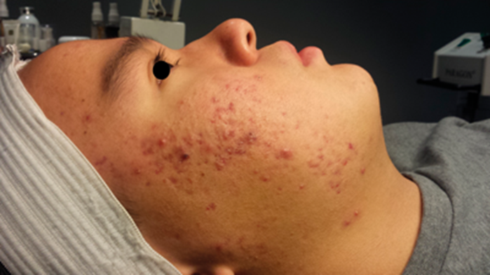 HOW I DO IT Approaches to acne treatment: LED therapy | The PMFA Journal