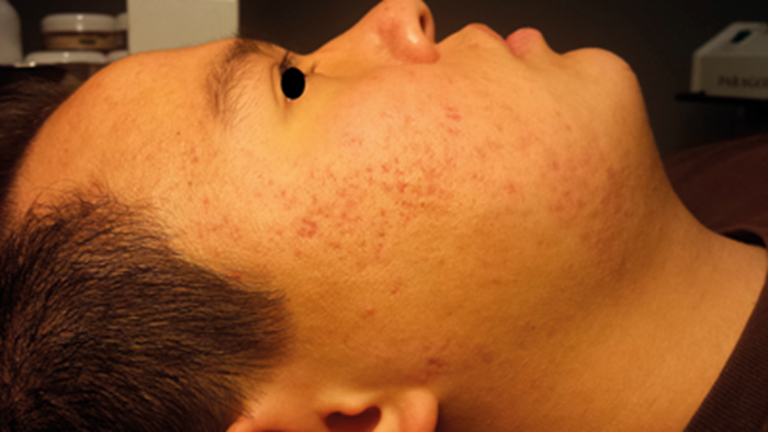 HOW I DO IT Approaches to acne treatment: LED therapy | The PMFA Journal
