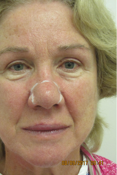 A suggested management pathway for rhinophyma and benign superficial ...