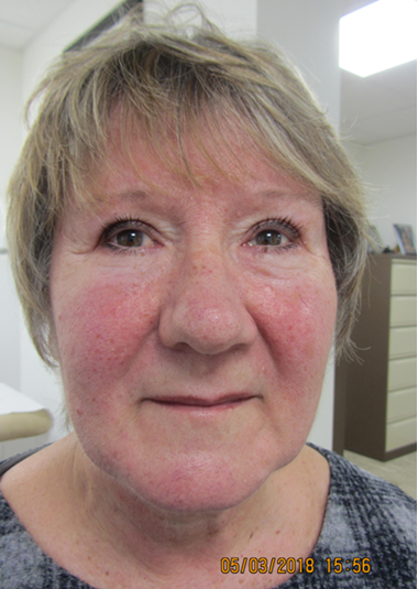 A suggested management pathway for rhinophyma and benign superficial ...