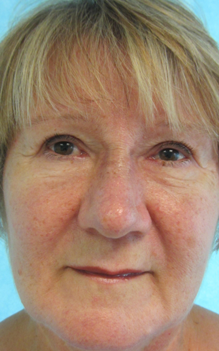 A suggested management pathway for rhinophyma and benign superficial ...