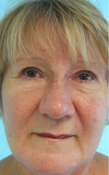 A suggested management pathway for rhinophyma and benign superficial ...