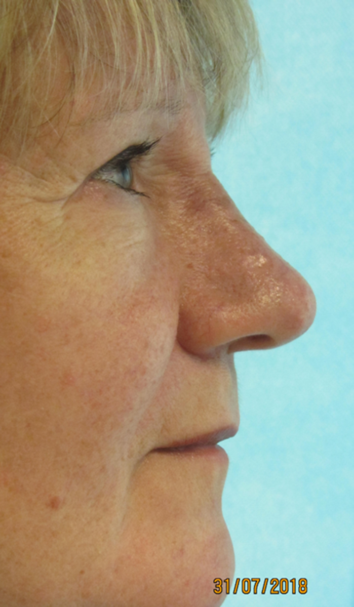 A suggested management pathway for rhinophyma and benign superficial ...