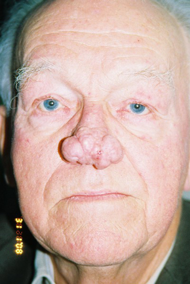 A suggested management pathway for rhinophyma and benign superficial ...