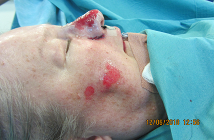 A suggested management pathway for rhinophyma and benign superficial ...