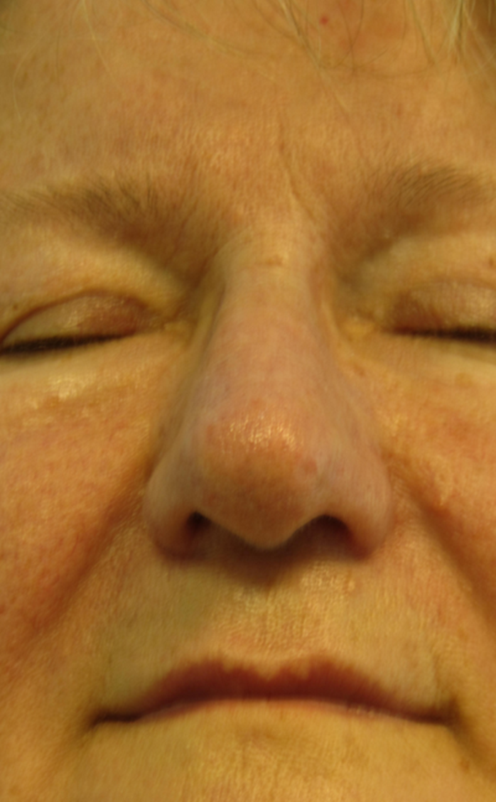 A suggested management pathway for rhinophyma and benign superficial ...