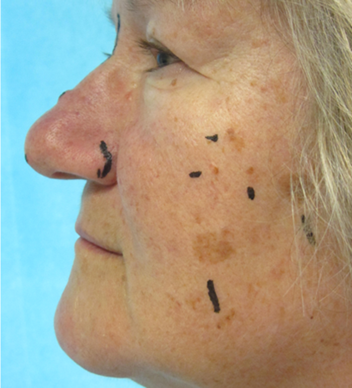 A suggested management pathway for rhinophyma and benign superficial ...