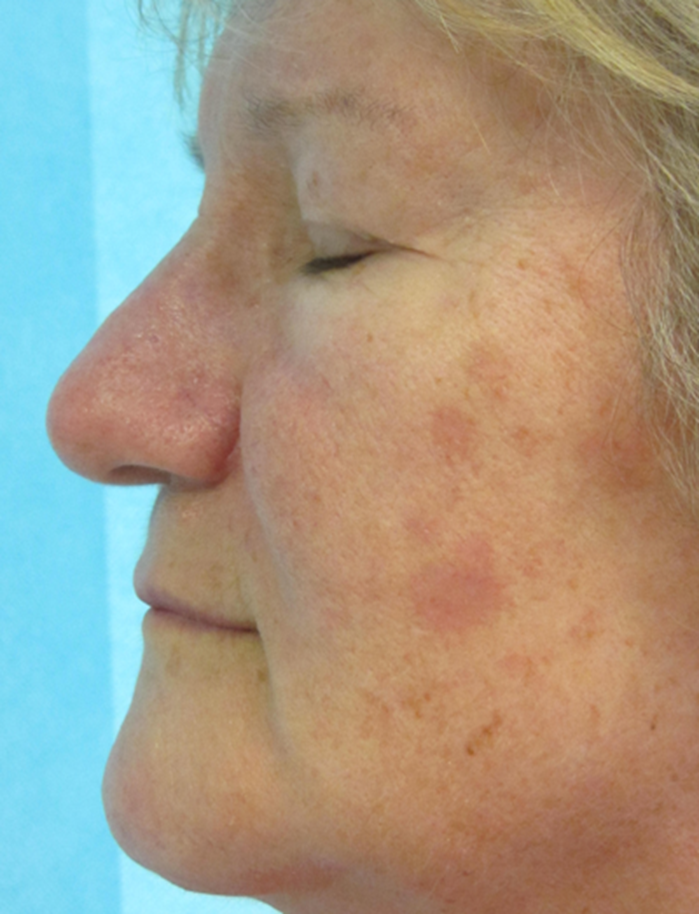 A suggested management pathway for rhinophyma and benign superficial ...