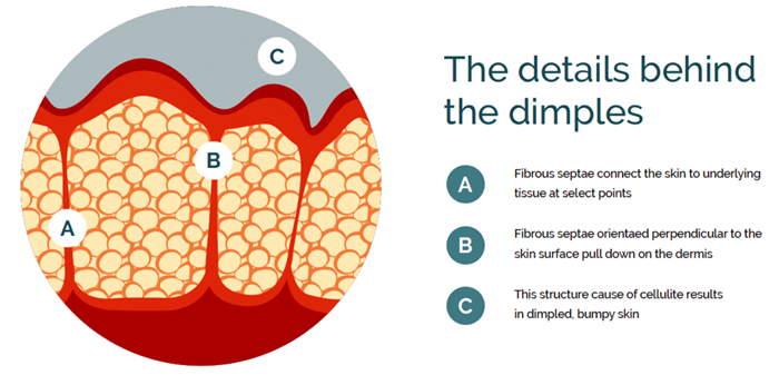 HOW I DO IT Treating cellulite: Cellfina | The PMFA Journal