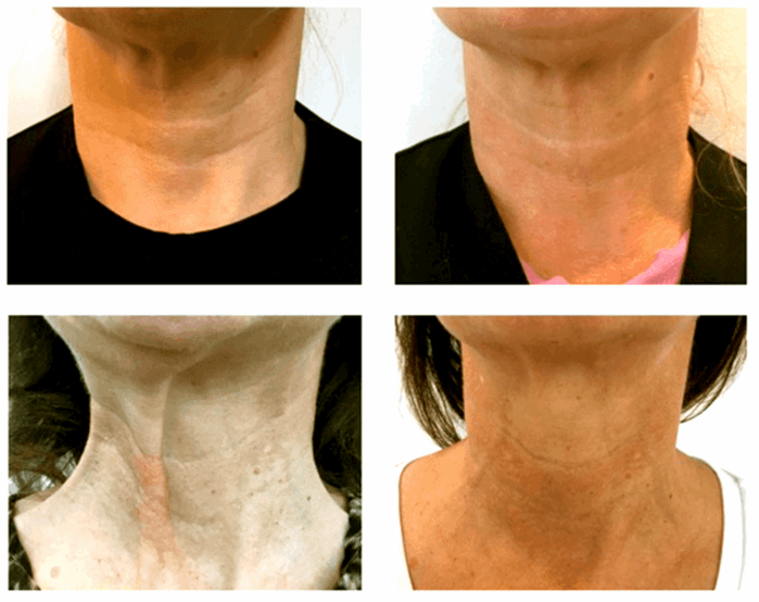 HOW I DO IT Neck rejuvenation with a multimodal approach: botulinum ...