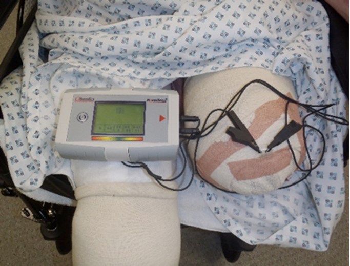 Wound moisture sensing in traumatic wounds | The PMFA Journal