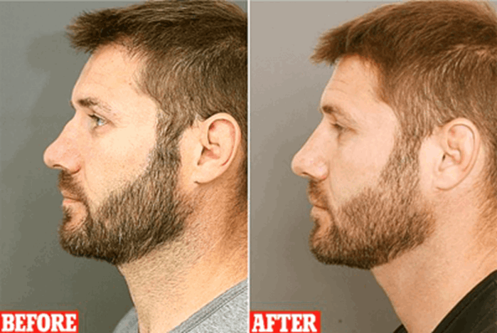 HOW I DO IT Combination treatment after nose trauma | The PMFA Journal