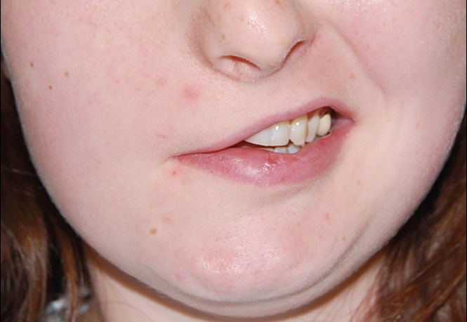 HOW I DO IT Surgical approach to facial palsy – lengthening the ...