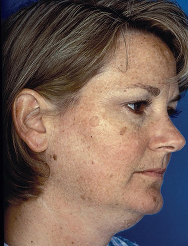 HOW I DO IT The original Blue Peel | The PMFA Journal