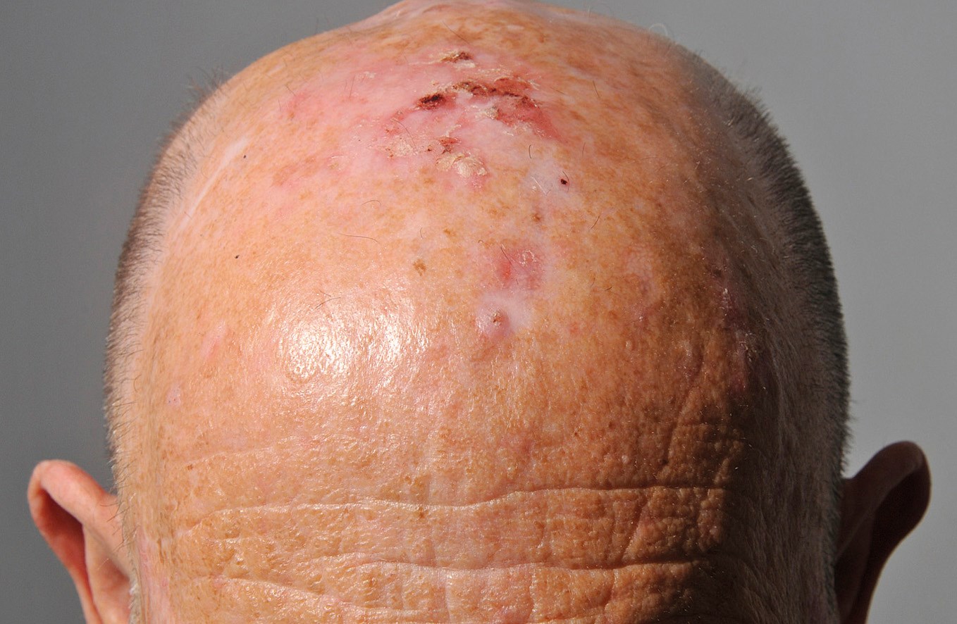 Non Surgical Management Of Actinic Keratosis Bowens Disease And Non