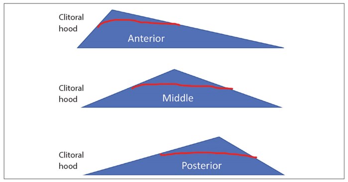 Cosmetic labiaplasty – basic relevant anatomy and surgical ...