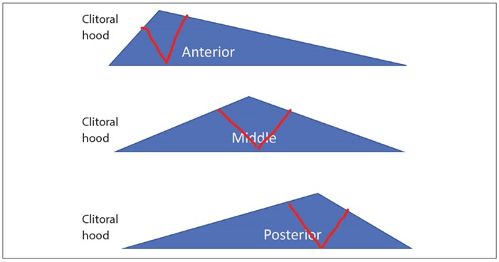 Cosmetic labiaplasty – basic relevant anatomy and surgical ...