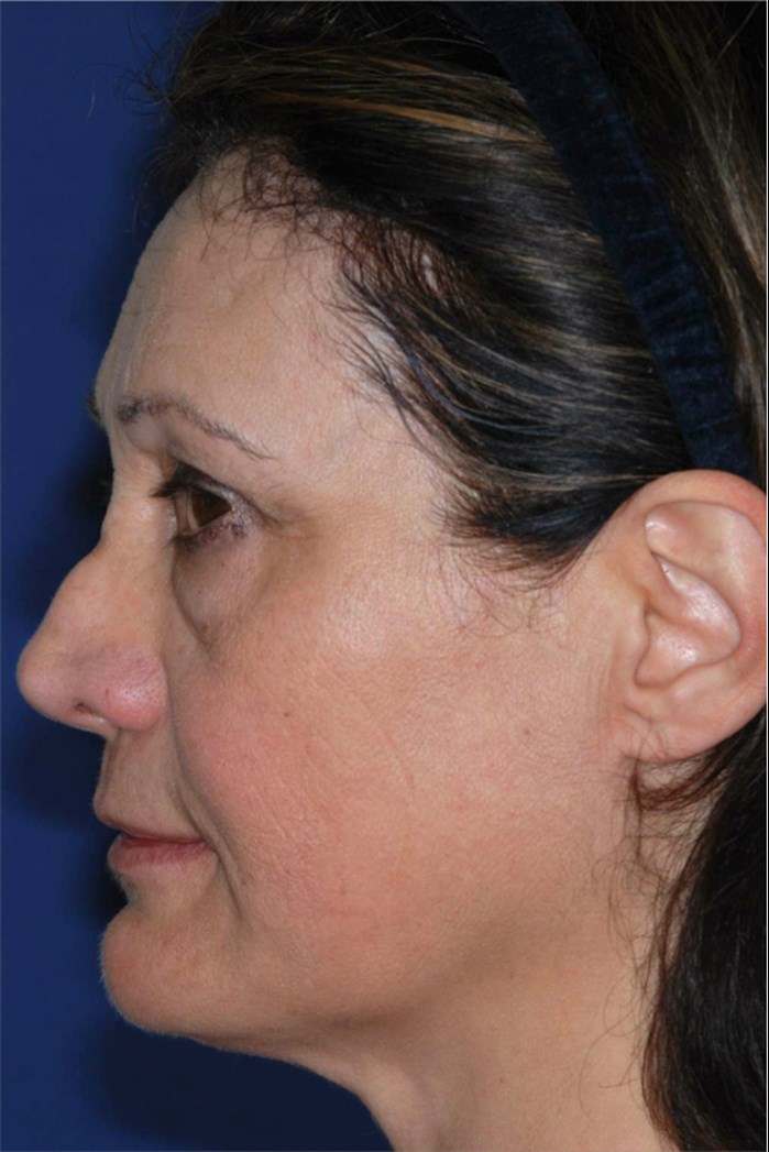 HOW I DO IT Aesthetic reconstruction of the nasal radix-rhinion complex ...