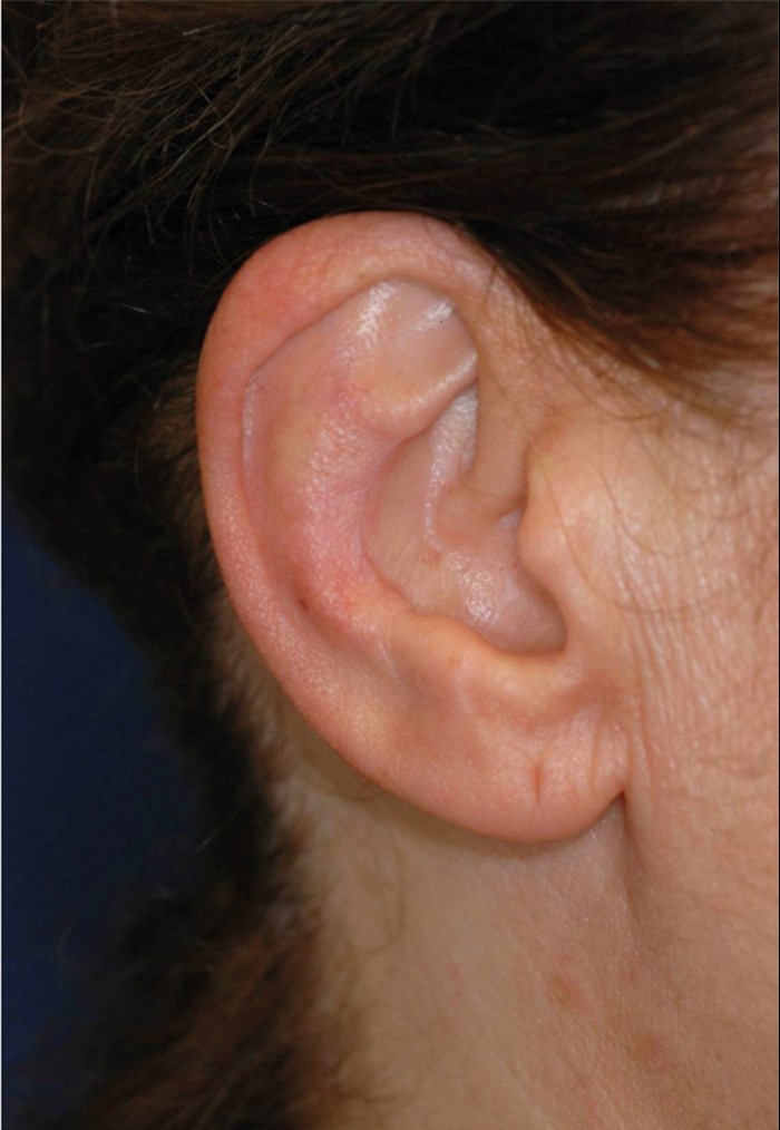HOW I DO IT Aesthetic reconstruction of the nasal radix-rhinion complex ...