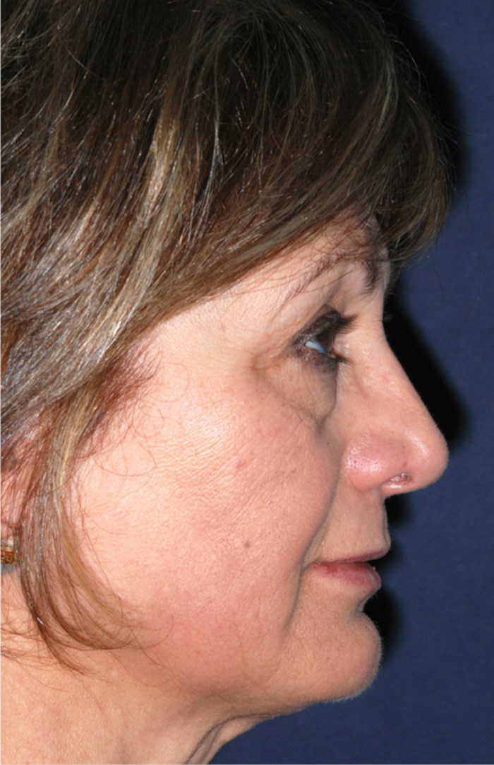 HOW I DO IT Aesthetic reconstruction of the nasal radix-rhinion complex ...