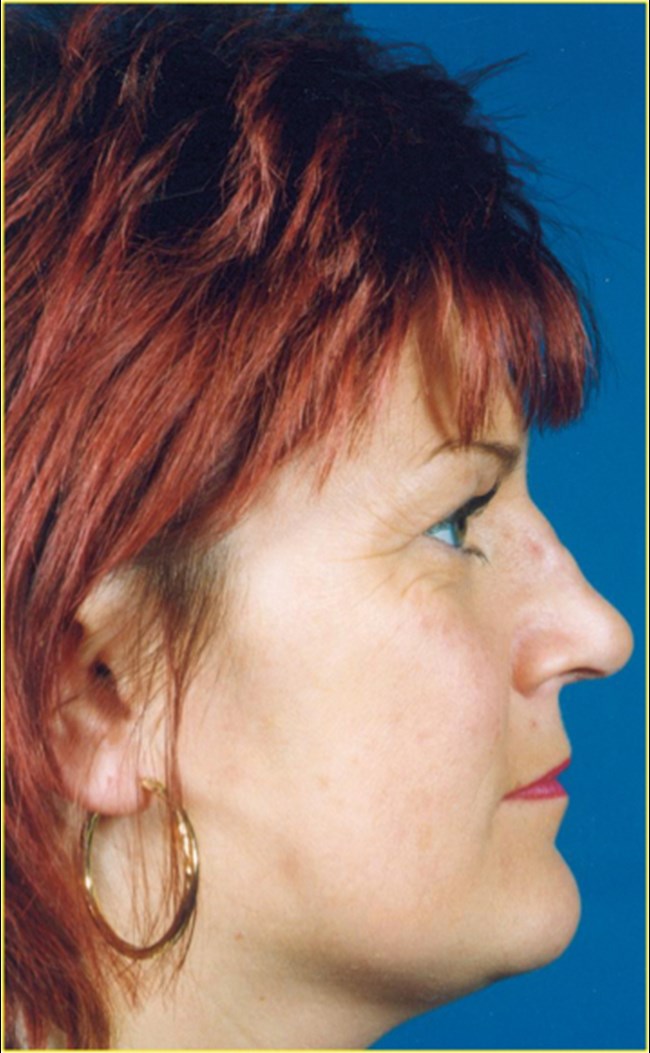 Augmentation rhinoplasty | The PMFA Journal