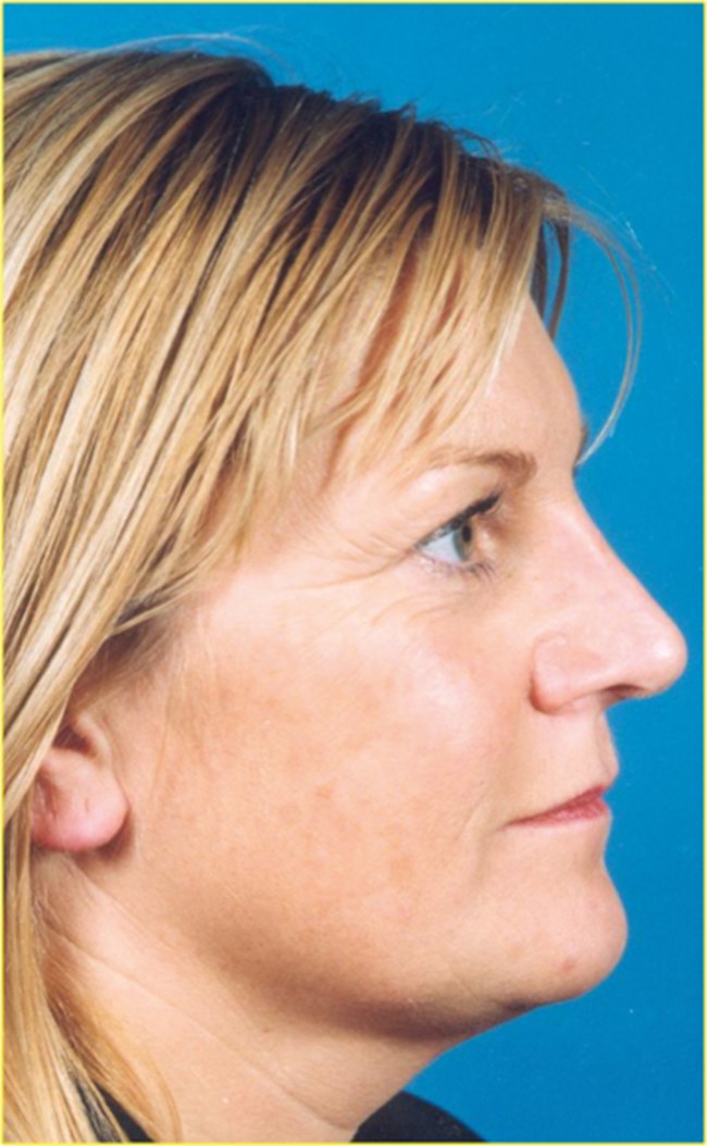 Augmentation rhinoplasty | The PMFA Journal