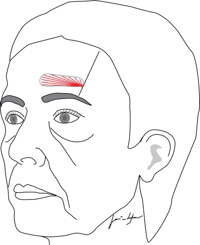 Rejuvenation of the forehead: correction of the frontal concavity | The ...