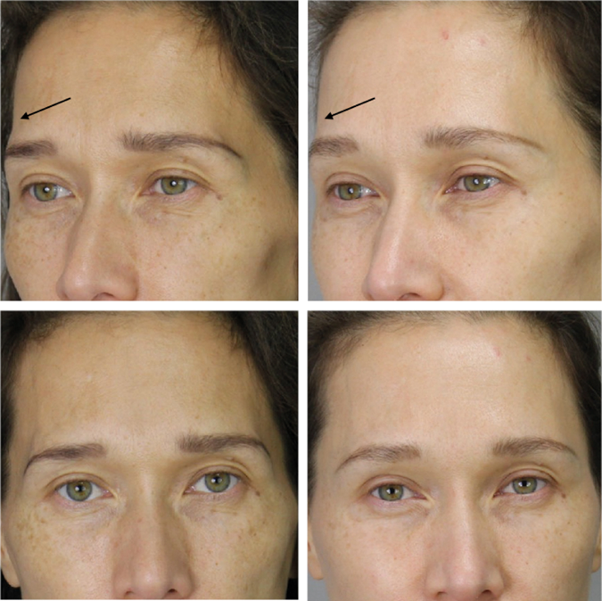 Rejuvenation of the forehead: correction of the frontal concavity | The ...