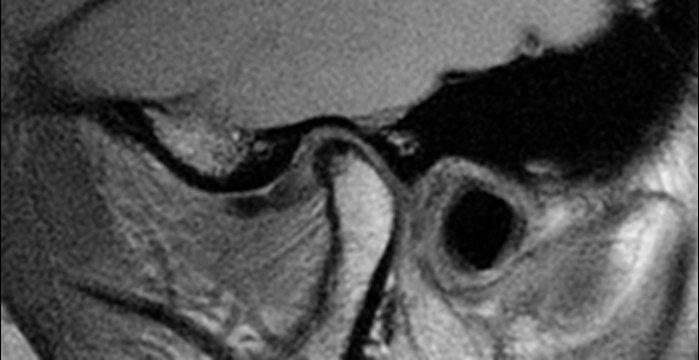 Temporomandibular disorders – a surgeon’s view | The PMFA Journal