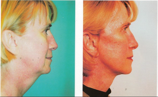 HOW I DO IT A guide to anterior neck lift aesthetic surgery | The PMFA ...