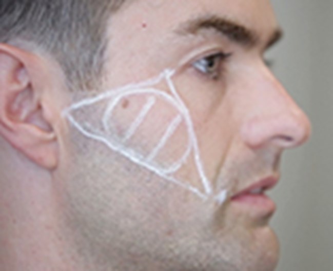 Treating the male patient with dermal fillers | The PMFA Journal