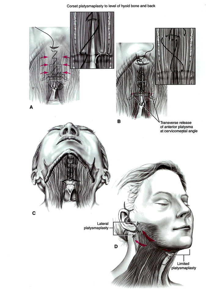 HOW I DO IT A guide to anterior neck lift aesthetic surgery | The PMFA ...