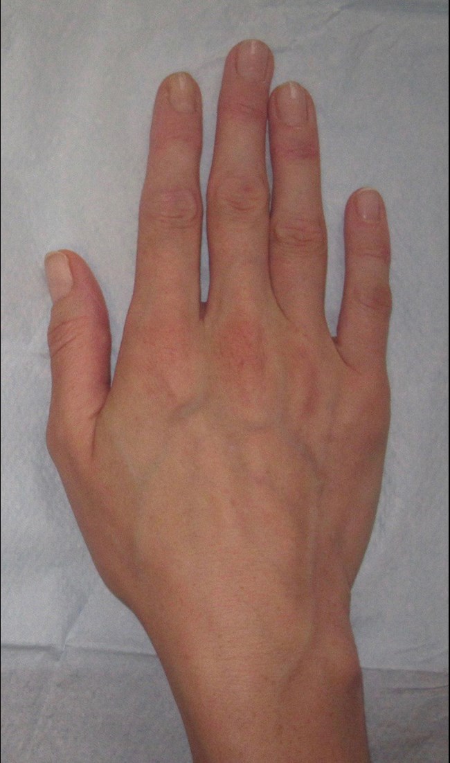 HOW I DO IT Dorsal hand rejuvenation with dermal fillers: anatomical ...