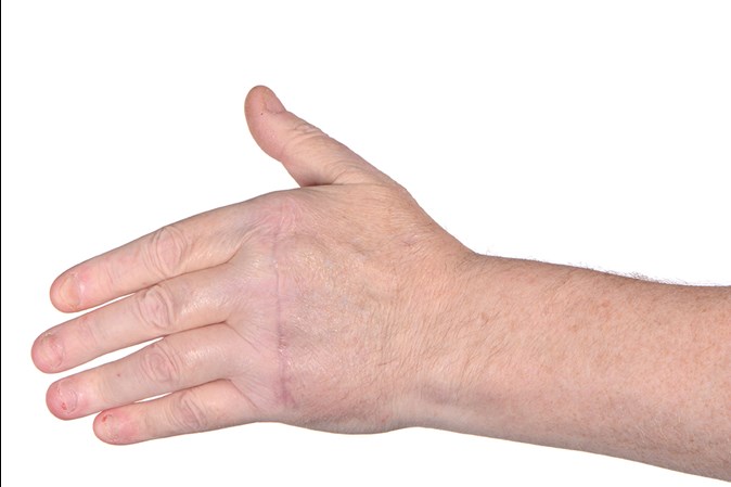 HOW I DO IT Treatment of rheumatoid arthritis in the hand: addressing ...