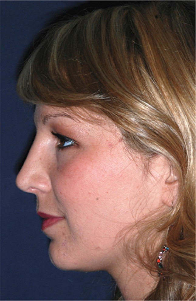 Emerging trends in the aesthetics of rhinoplasty: from local to global ...
