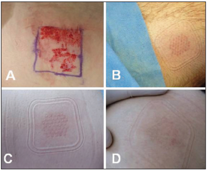Could epidermal grafting be the solution to vitiligo? | The PMFA Journal