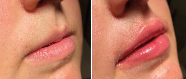 HOW I DO IT - Lip augmentation with hyaluronic acid | The PMFA Journal