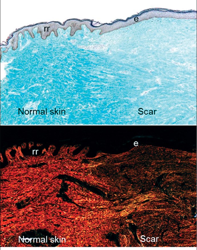 The role of angiogenesis in wound healing, scarring and tissue ...