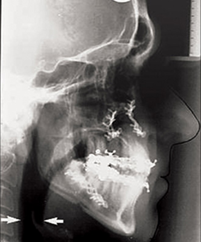 The role of maxillomandibular advancement surgery in obstructive sleep ...