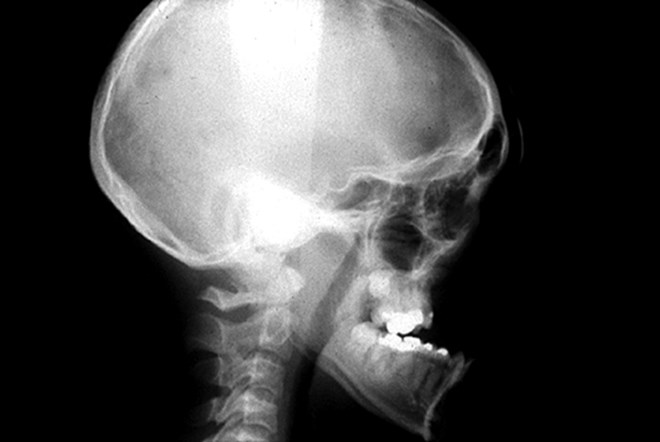 The role of maxillomandibular advancement surgery in obstructive sleep ...