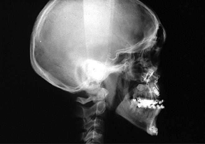 The role of maxillomandibular advancement surgery in obstructive sleep ...