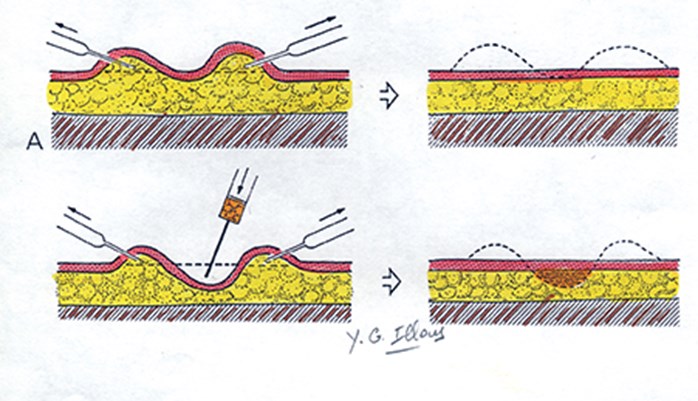 Combined procedures: lipo-abdominoplasty and lipo-inner thighplasty ...