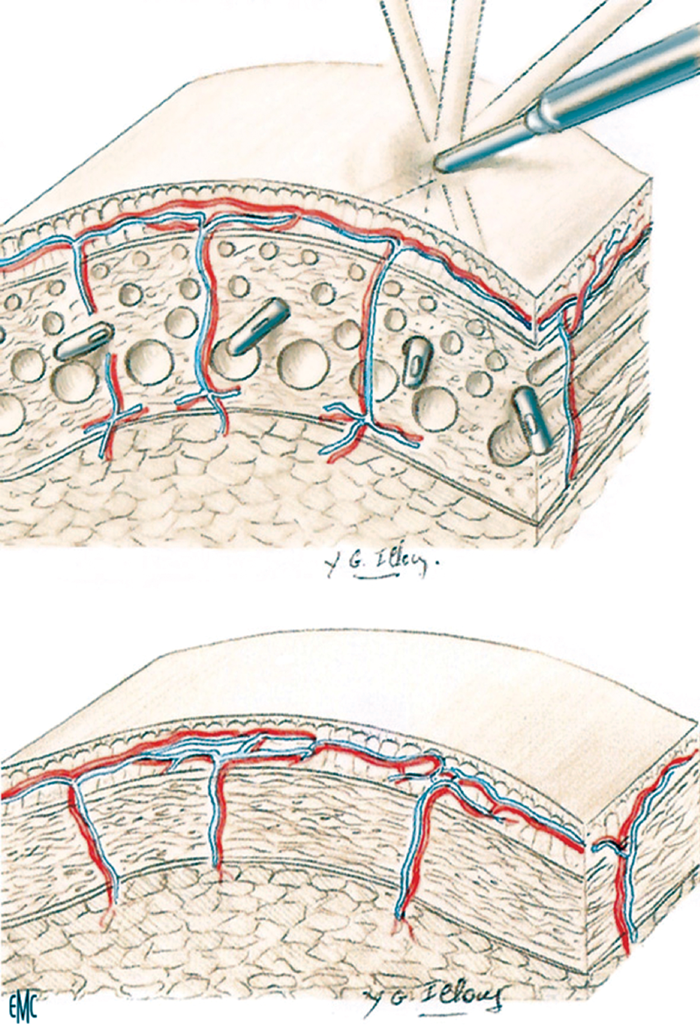 Liposuction – the evolution of the classical technique | The PMFA Journal