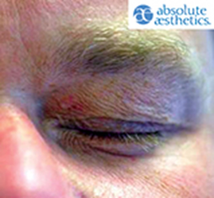 Xanthelasma | The PMFA Journal