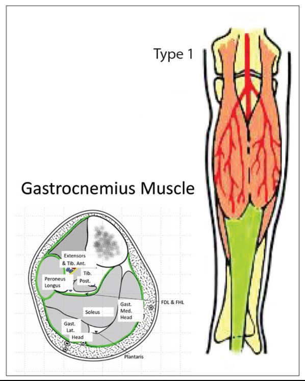 The medial gastrocnemius flap | The PMFA Journal