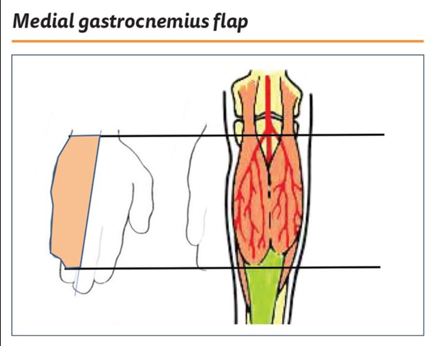 The medial gastrocnemius flap | The PMFA Journal