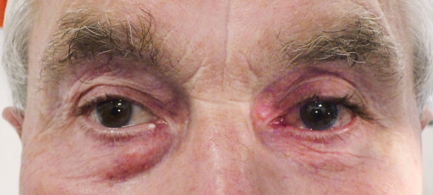 Prostaglandin associated periorbitopathy presenting as unilateral ...