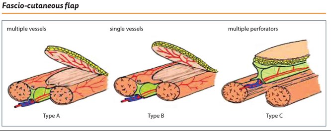 The medial gastrocnemius flap | The PMFA Journal