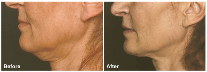 Facial rejuvenation with the Profound RF System | The PMFA Journal