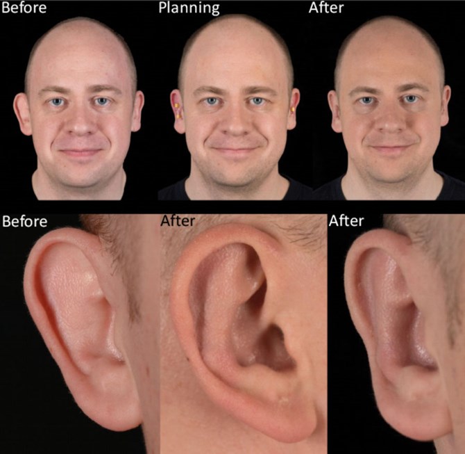 HOW I DO IT Earfold*®* : A new technique for the correction of ...